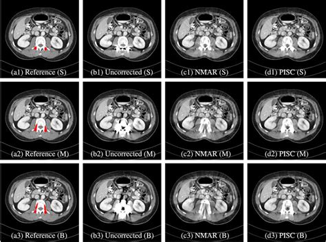 The Performance Of The Presented Pisc Method On Three Ti Metal Implants Download Scientific