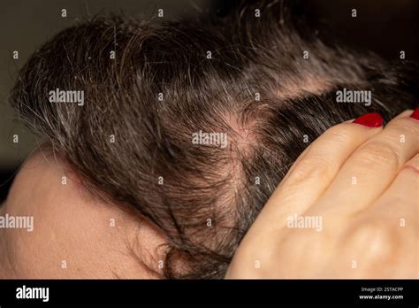 Scalp Psoriasis Characterized By Red Patches And Scaly Skin