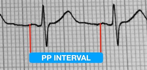 Ecg Segments And Intervals — The Pr