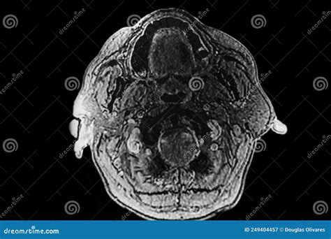 Cat Scan Of Brain Tumor Stock Image Image Of Brain 249404457