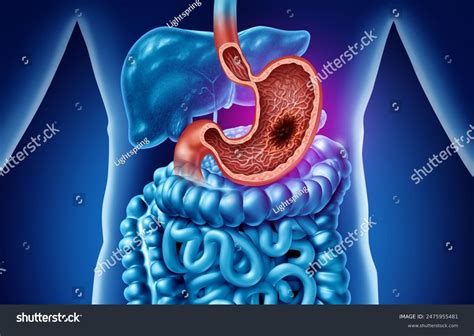 Gastric Cancer Stomach Tumor Digestive System Stock Illustration
