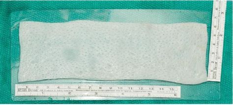Native Alloderm With Dimensions Of 6 Cm × 17 Cm 102 Cm² And Having A