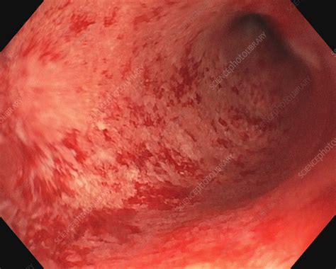 Colon In Ulcerative Colitis Endoscope View Stock Image C Science Photo Library