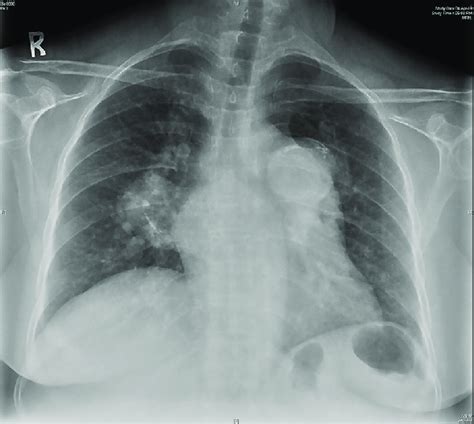 Chest X Ray Revealed A Dilated Right Atrium Dilated Calcified Main Download Scientific
