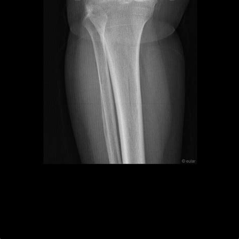 X Ray Of The Wrist Calcifications Of The Tfcc Asterisks By Cppd Download Scientific Diagram