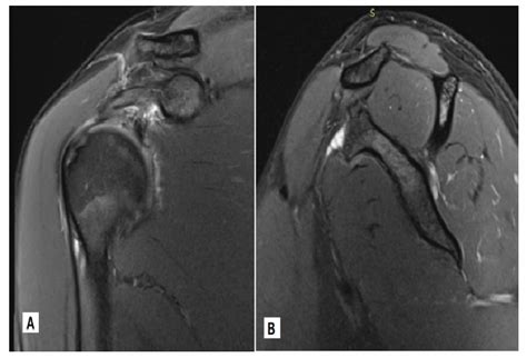 A T2 Sequence Shows Glenoid Fracture In Coronal Section And B T2