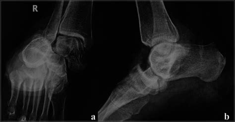 Subtalar Dislocations Pmc