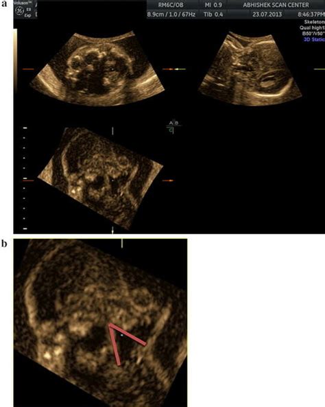 1 A Vermian Hypoplasia—inferior Lobe Of Vermis Small With Marginal