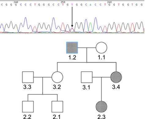 A Heterozygous Missense Mutation Identified In A Proband Her Father