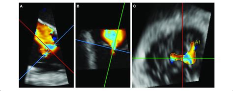 Example Of 3d Doppler Vc Area Using Multiplanar Reconstruction Ab
