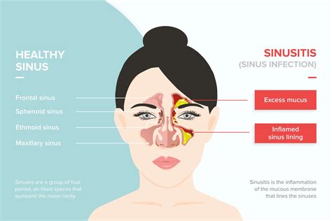 Maxillary Sinus Inflammation Treatment