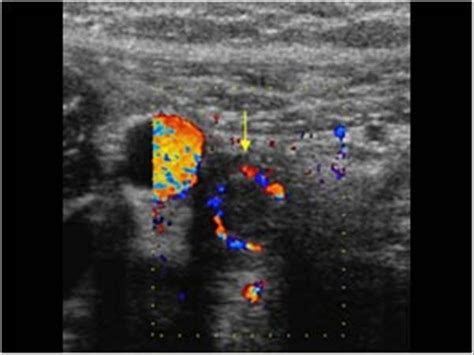 Abdomen And Retroperitoneum 1 5 Appendix Case 1 5 2 Uncomplicated