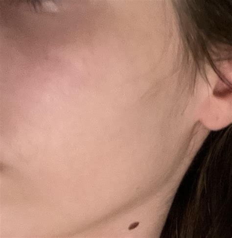 Huge Dark Hyperpigmentation After Pimples Racne