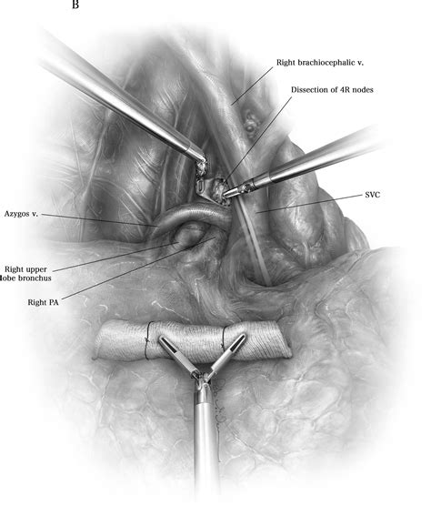 Robotic Right Lower Lobectomy Operative Techniques In Thoracic And