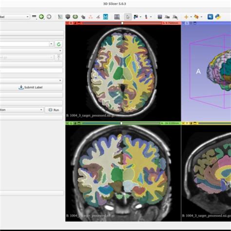 Figure B15 Server Based Whole Brain Segmentation Using Large Unest