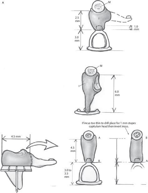 Ossicular Chain Reconstruction Ento Key