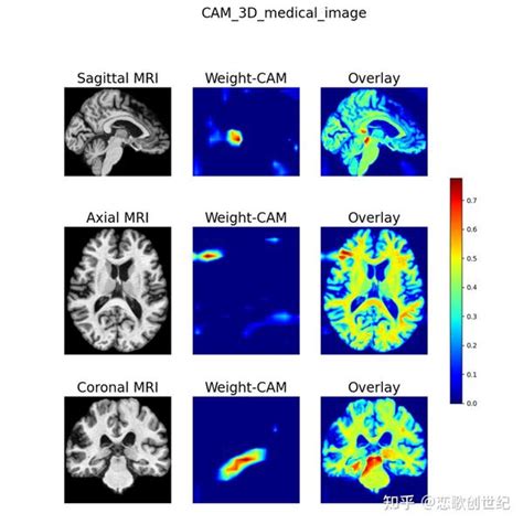 基于三维医学影像数据的CAM可视化PyTorch实现 知乎