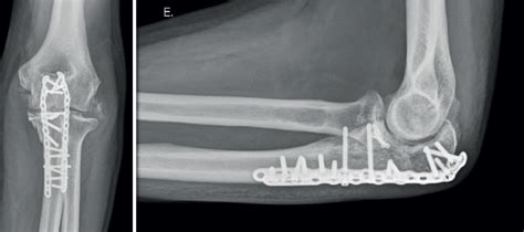 Fracturas De La Apófisis Coronoides ¿cuándo Tratarlas Fondoscience