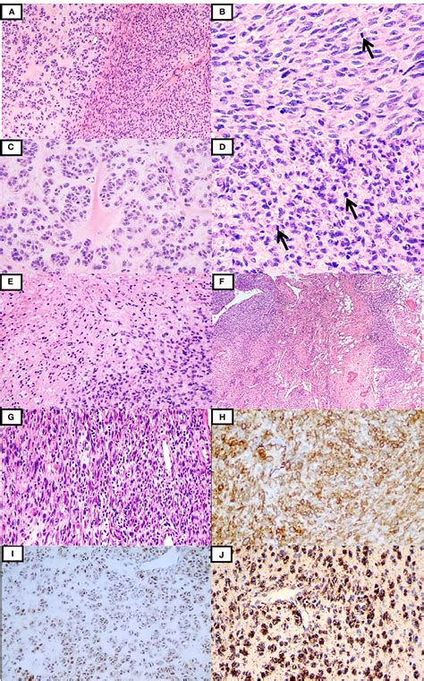 Spindle Epithelioid Cells At Louis Perry Blog