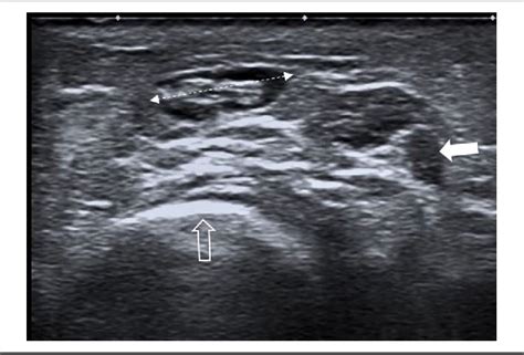 Figure 3 From Sonographic Diagnostic Of An Adventitial Bursitis On The Distal Forearm A Case