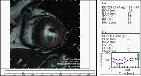 Segmentation Of The Left Ventricle And Extraction Of Cardiac