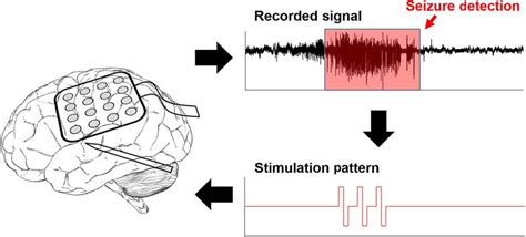 concept diagram of closed loop stimulation for seizure suppression