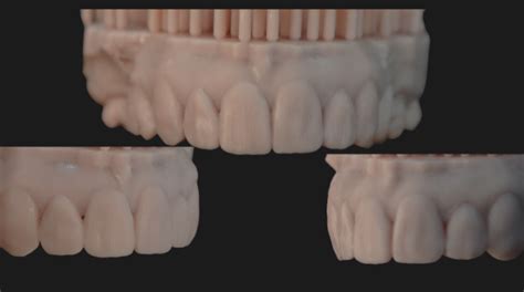 Using 3d Wax Ups In Gingivectomy Cases Clinical Analysis And 3d Aesthetic Guide Smilefy