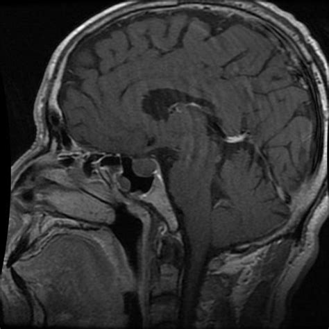 Pitutary Object Detection Dataset By K2s