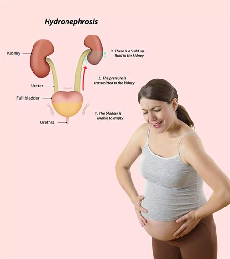 Uti During Pregnancy Causes Symptoms Risks And Treatment