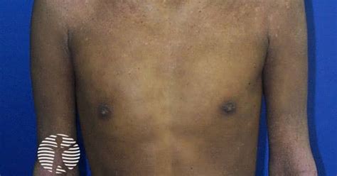 Atopic Eczema Image