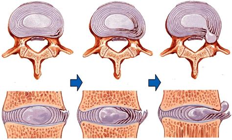 Протрузия межпозвонковых дисков симптомы признаки и причины диагностика и лечение