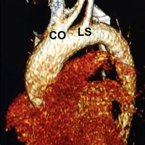Population Variations In Branching Pattern Of The Aortic Arch Download Scientific Diagram