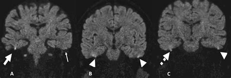 Susceptibility Artefact Scores For Rs Epi Examples 0 No Artefact Download Scientific Diagram
