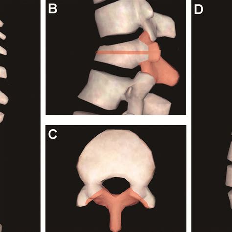 Schematic Illustration Of Modified Closing Opening Wedge Osteotomy