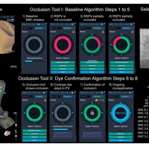 Cryoballoon Ablation Guided By Dielectrical Information Of The Download Scientific Diagram