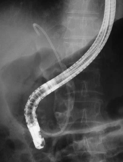 Retrograde Cholangiogram 2 Months After Stent Placement In Same Patient