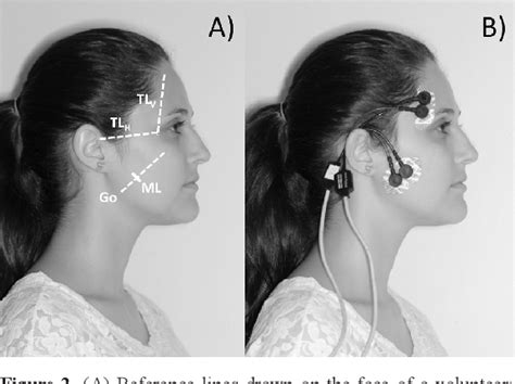 Figure 1 From Proposal Of Surface Electromyography Signal Acquisition Protocols For Masseter And
