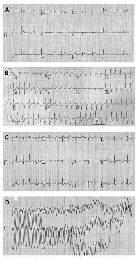Electrocardiographic Assessment At Baseline And Follow Up A Baseline Download Scientific