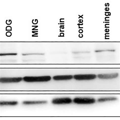 The Presence Of Pyruvate Carboxylase In Glioblastoma The Pyruvate Download Scientific Diagram