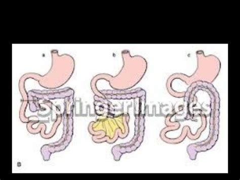 Clinical Case Asr Laparoscopic Ladds Procedure For Malrotation Corre…