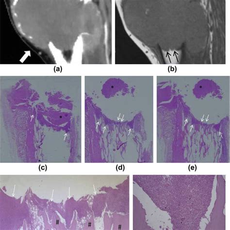 A 64 Year Old Woman With Gctb In The Proximal Tibia Had A History Of