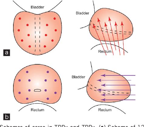 Figure 1 From Comparison Of Diagnostic Efficacy Between Transrectal And Transperineal Prostate