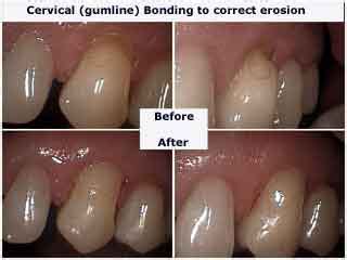 Abrasion Teeth Treatment