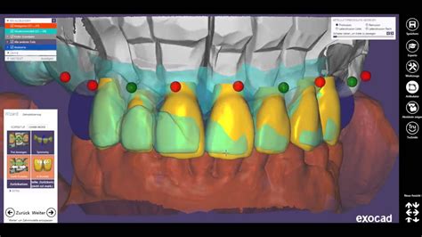 Exocad Wiki File RegistrazioneModelliExocadIta Exocad