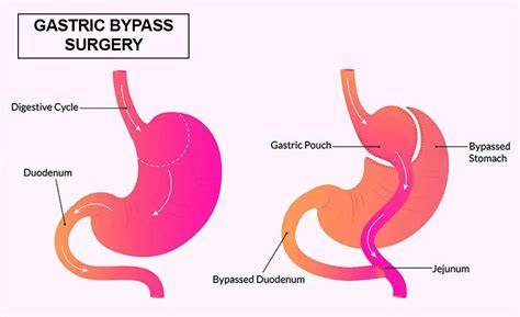 Robotic Weight Loss Surgery Da Vinci Bariatric Surgery