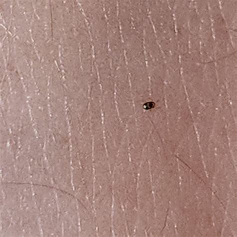 What Are These Tiny Bugs I Keep Finding On My Skin Rpestcontrol