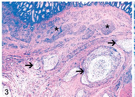 Plexiform Neurofibroma Histology