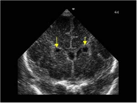 Pediatrics Neonatal Brain And Spine Case Hemorrhage And Periventricular Cysts