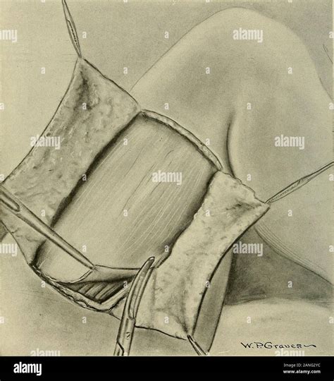 Gynecology Covered With A Sterile Dressing Withthe Patient Still On Her Back The Right Leg