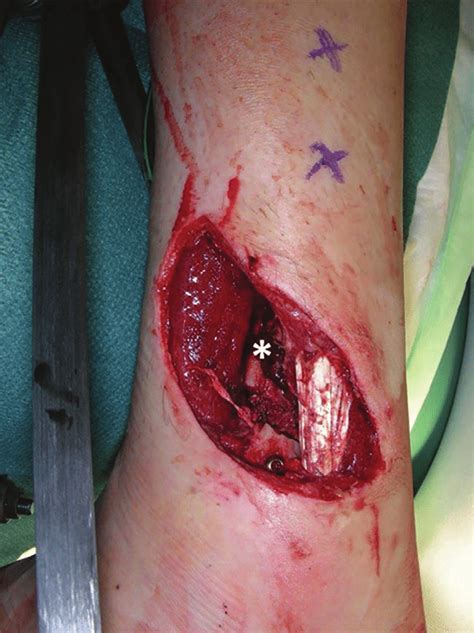 Preoperative Situs Tibial Fracture With Exposed Bone And Implanted Screw Download